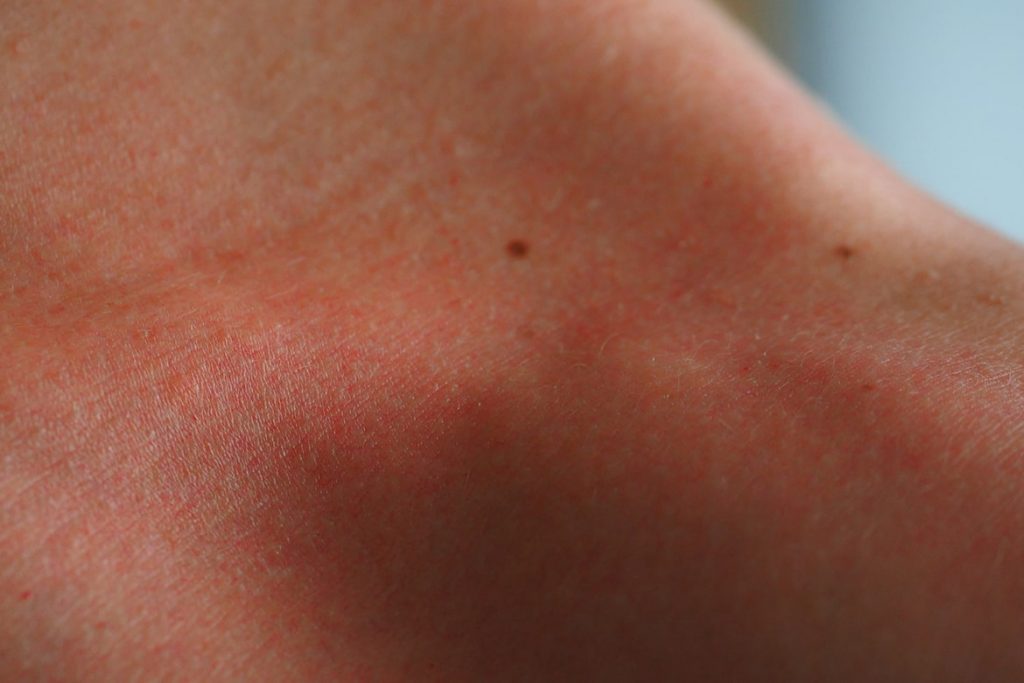 3 Natural Sunburn Remedies That Really Work (And One That Doesn't)