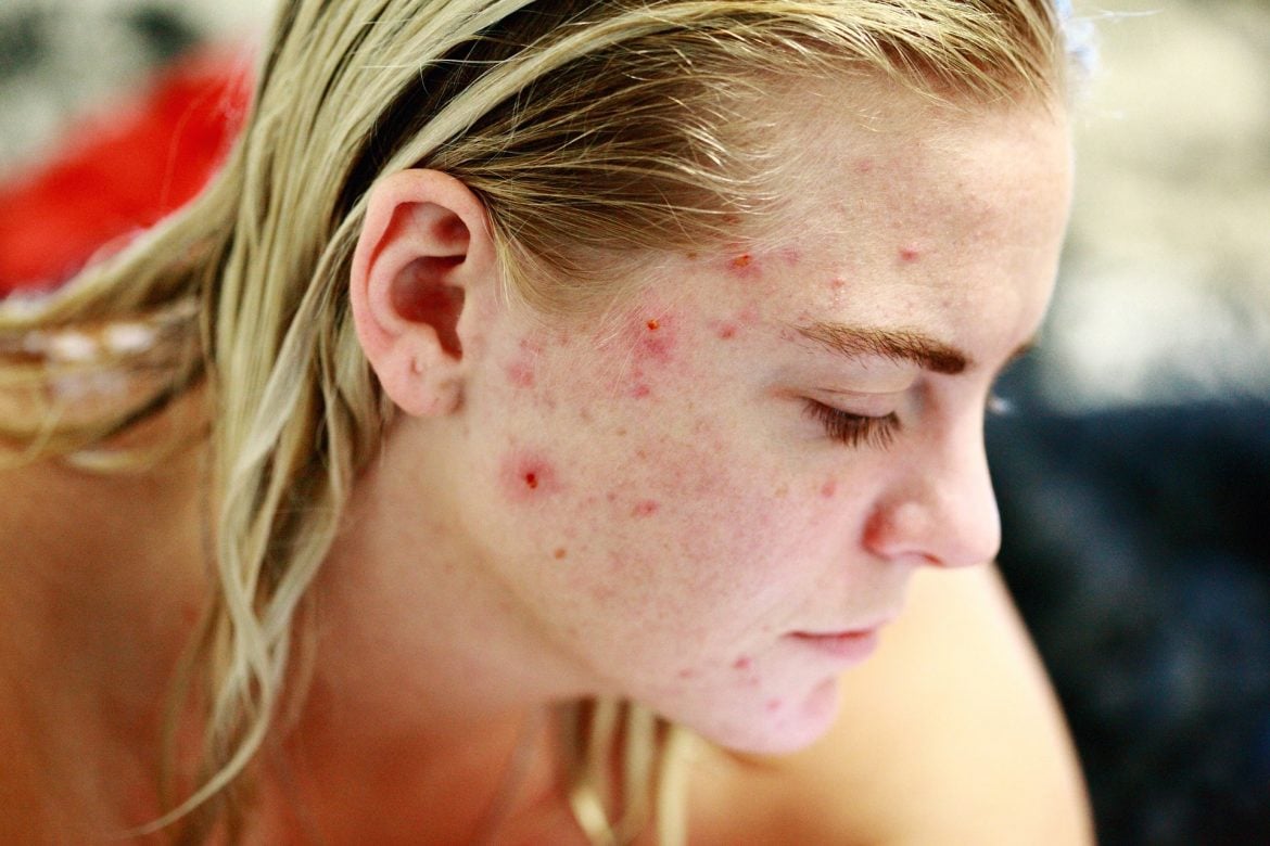 Acne Marks Vs Acne Scars: Difference, Causes, & Treatments